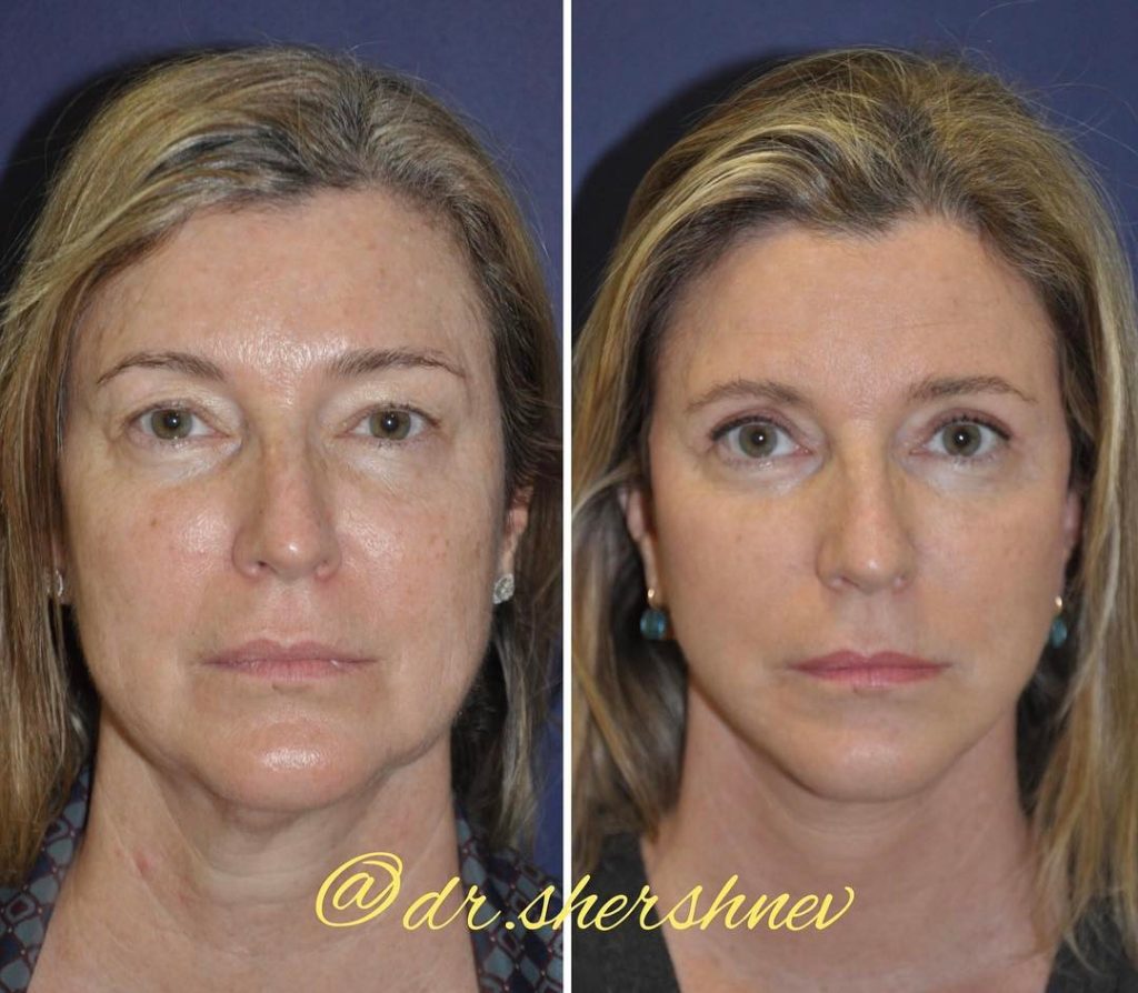 Lifting Facial SMAS - Dr. Dmitry Shershnev