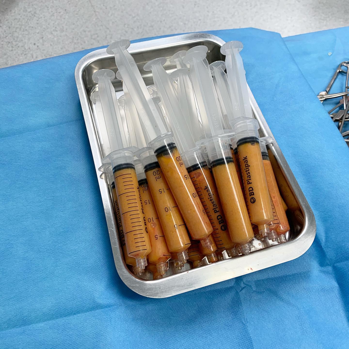 ¿Piel Sobrante en el Abdomen? La Solución definitiva