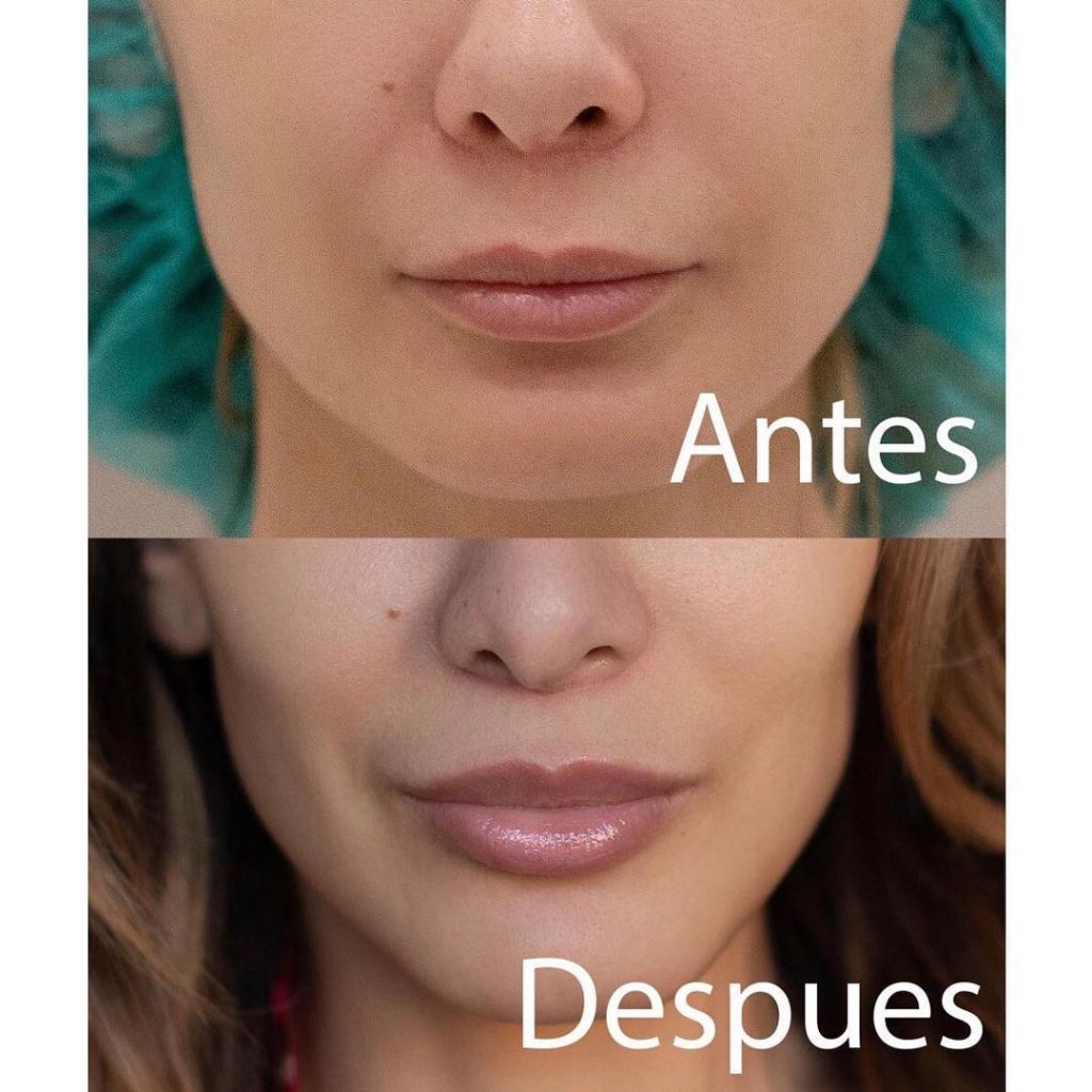 Cheiloplasty Dr Dmitry Shershnev Cheiloplasty Dr Dmitry Shershnev